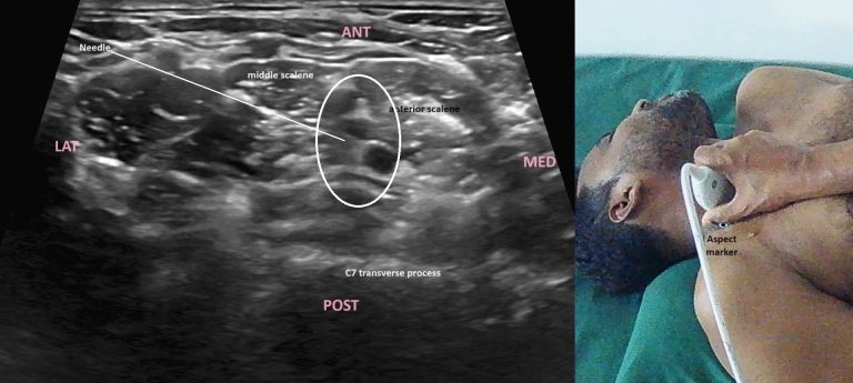 Usg Guided Brachial Plexus Block A Precision Approach